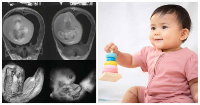 Feto en feto: médicos extraen “gemelo parásito” desde el cerebro de una ...